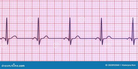 A Normal Electrocardiogram 3d Illustration Stock Illustration Illustration Of Diagnostic