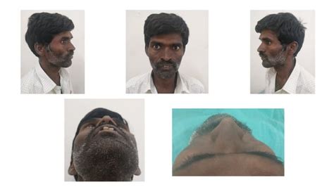 Presentation On Carcinoma Of Buccal Mucosa Ppt