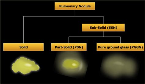The Radiology Assistant Fleischner 2017 Guideline For Pulmonary Nodules