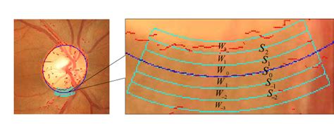 Figure 4 From Automatic Optic Disc Segmentation With Peripapillary Atrophy Elimination