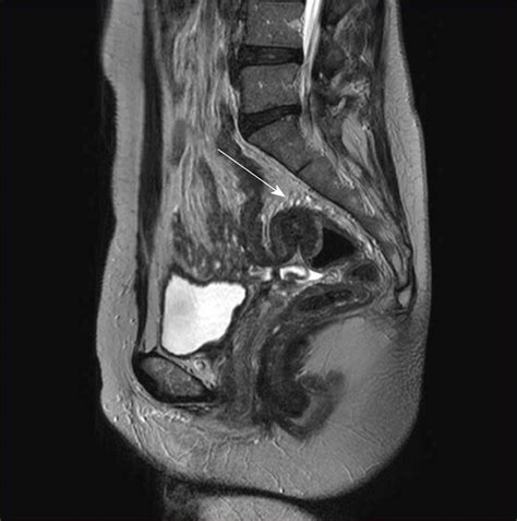 Magnetic Resonance Imaging T2 Weighted Sagittal Image A Mass Like Download Scientific Diagram