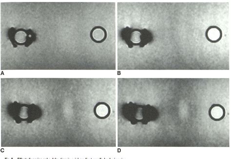 Figure 1 From Gradient Recalled Echo Mr Imaging Magnetic