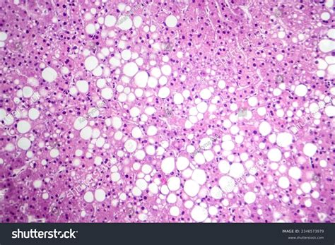 Photomicrograph Hepatic Steatosis Revealing Fat Accumulation Stock