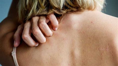 Causes Symptoms And Treatments Of Hives Entirely Health