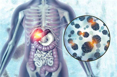 병은 간의 의학적으로 정확한 그림 바이러스는 간을 감염 3d 일러스트레이션 간 내부 기관에 대한 스톡 사진 및 기타 이미지 간 내부 기관 질병 섬유증 Istock