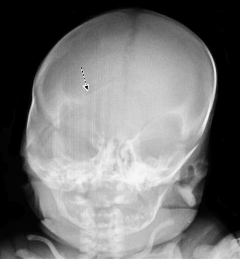Lambdoid Craniosynostosis Neupsy Key