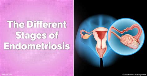 The Different Stages Of Endometriosis