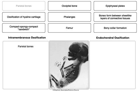 Solved Parietal Bones Occipital Bone Epiphyseal Plates Ossification Of