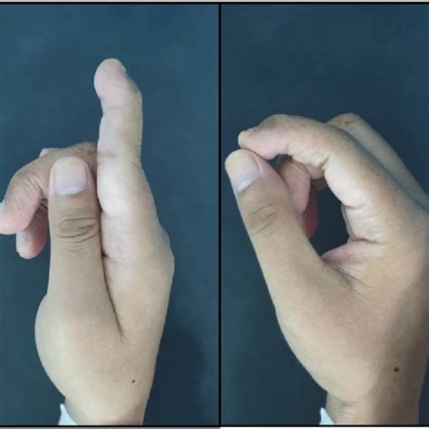Steps Of Terminal Extensor Tendon Reconstruction A Approach To The