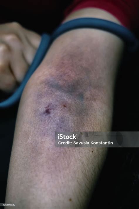 정맥에 마약의 복용량을 복용하기 전에 공포와 성인 소녀 정맥에 대한 스톡 사진 및 기타 이미지 정맥 팔 신체 부분 땋은 머리 Istock