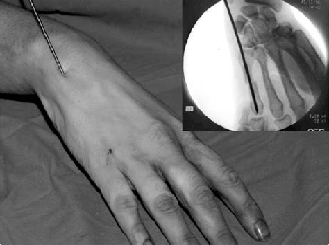 The Distal End Of K Wire Is Pulled Up To Metacarpal Head Download Scientific Diagram