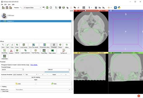 Overview 3d Slicer Segmentation Recipes