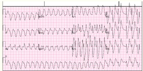Broad Complex Tachycardia Flashcards Quizlet