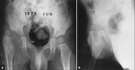 X Ray Pelvis Both Hips A And R Hip Joint B Anteroposterior View
