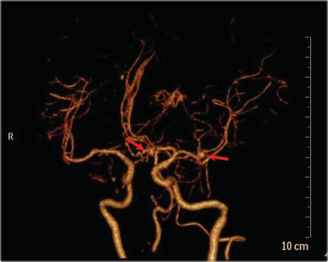 Digital Subtraction Angiography Demonstrated Saccular Aneurysms Of The Download Scientific