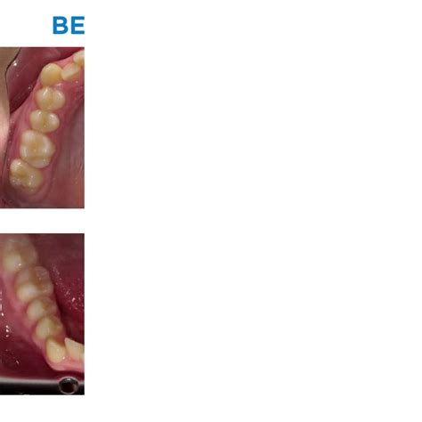 Dentsply Sirona On Linkedin Class Ii With Moderate Crowding High Cuspids And Moderately Deep