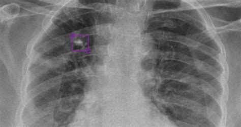 Deeptek Detects Tuberculosis From X Rays With Ai Nvidia Blog