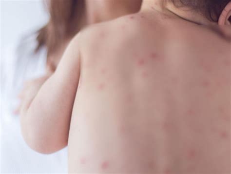 Улаанбурхан өвчин Улаанбаатар хот Өмнөговь Дундговь аймагт голомтлон бүртгэгдэж байна