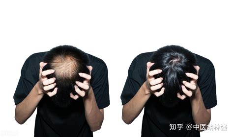两鬓斑白头顶白发还在染发变黑发吗中医给你3个生发乌发方 知乎