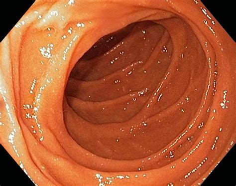 Normal Endoscopy Results