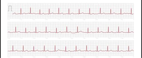 Prolonged Qtc Interval R Readmyecg