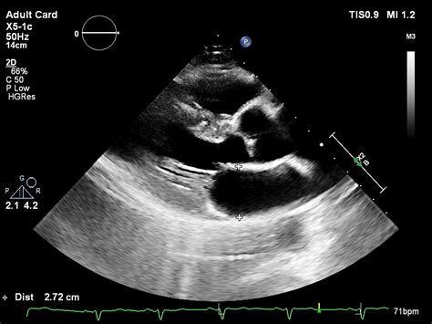 Early Echocardiographic Predictors For Atrial Fibrillation Propensity