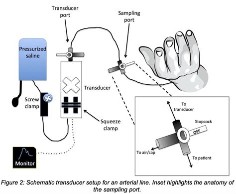 Arterial Line Transducer Set Up My XXX Hot Girl