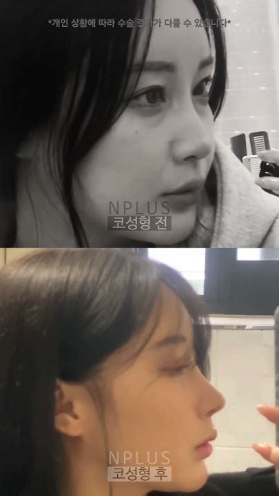 코성형 풀페이스 지방이식 💕🩷💕🩷 Shorts Youtube