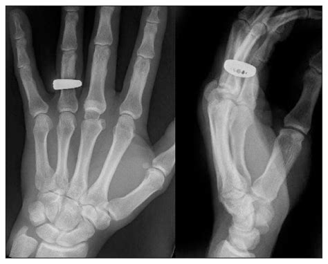 Metacarpal Head