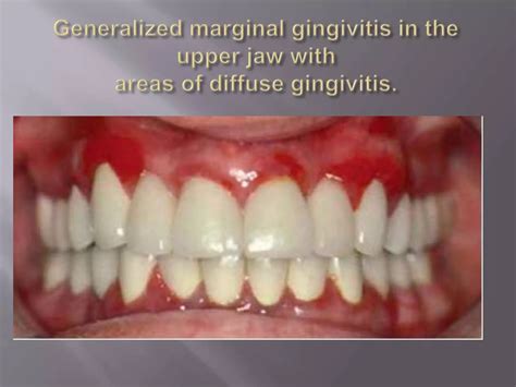 Clincial Features Of Gingivitis Ppt