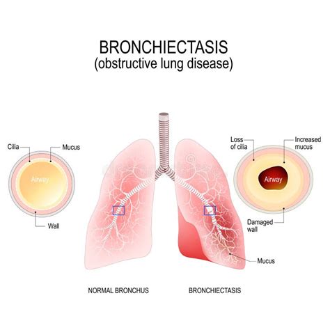 Normale Bronchie En Bronchiectasis Obstructieve Longziekte Vector