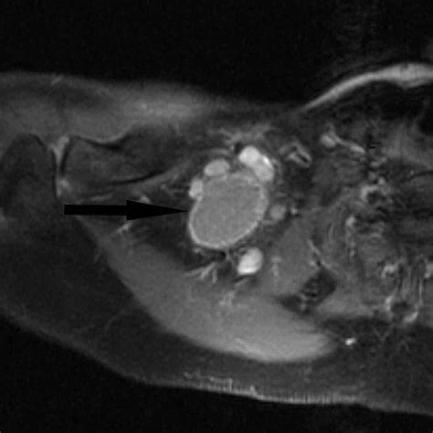 Right Brachial Plexus Mri T1 Weighted Showing The 33cm X 27cm Mass