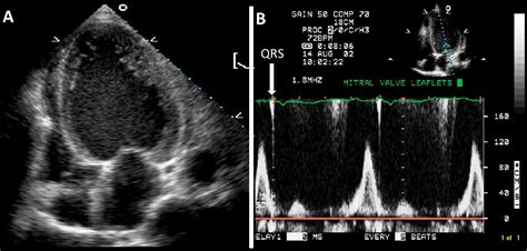 Normal Echocardiogram