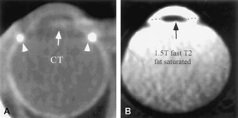 Figure 5 From In Vivo Ct And Mr Appearance Of Prosthetic Intraocular