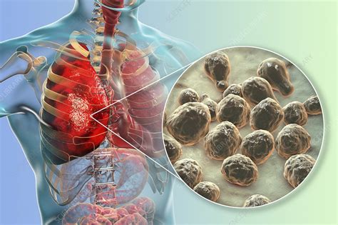 Pulmonary Cryptococcosis Illustration Stock Image F0338019