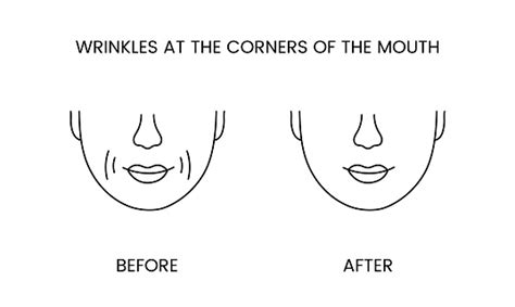 입가의 주름 시술 전과 벡터에 치료 라인 아이콘을 적용한 후의 레이저 미용 매끄럽고 깨끗한 피부와 주름을 가진 남자의 삽화