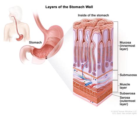 Adenocarcinoma Of The Stomach Lining
