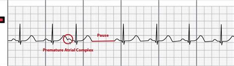 Premature Atrial Contraction Strip