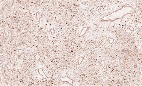 Spindle Cells Desmoid Tumor At Ella Byatt Blog