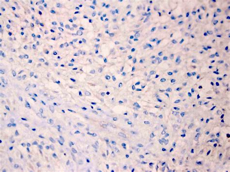 Pathology Outlines Ossifying Fibromyxoid Tumor