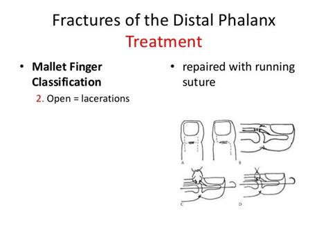Distal Phalanx Fracture