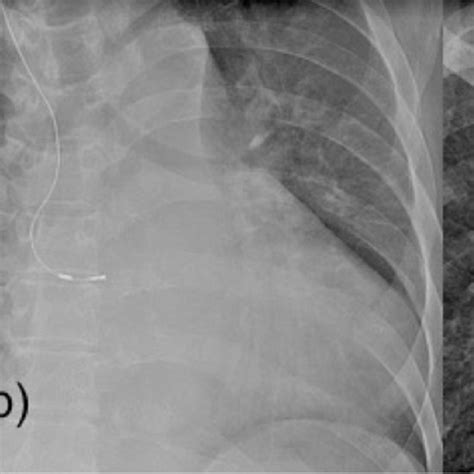 Placement Of A Pacemaker Leads As A Fiducial Marker A Fiducial Marker
