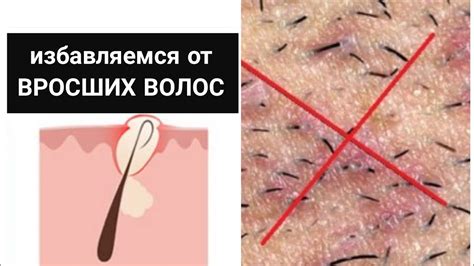 Как избавиться от вросших волос в зоне бикини и подмышек навсегда за 5