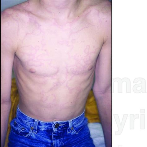 Diagnostic Algorithm 1 Differentiation Between Hereditary Angioedema