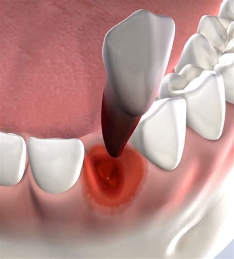 Oral Surgeon Springfield Oral And Facial Surgeons Of Illinois Located