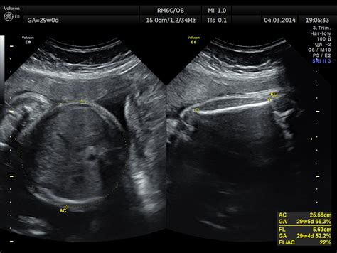 Choroid Plexus Cyst Looking Through A Transducer