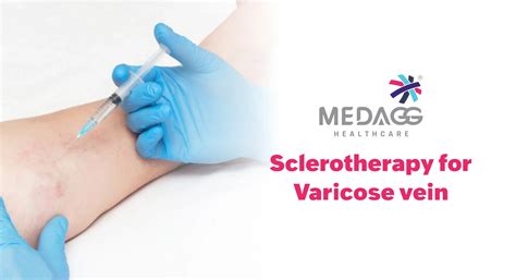 Operation For Varicose Veins Treatment And Recovery Guide Medagg