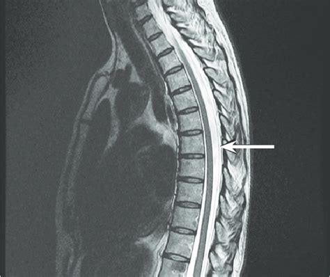 What Is A Mri Thoracic Spine At Maxine Smith Blog