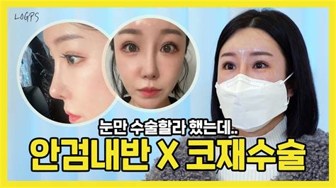 로그성형외과 코재수술안검내반하고 더 이뻐졌어요 Youtube