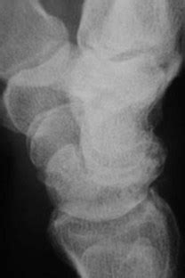 Proximal Row Carpectomy Plastic Surgery Key